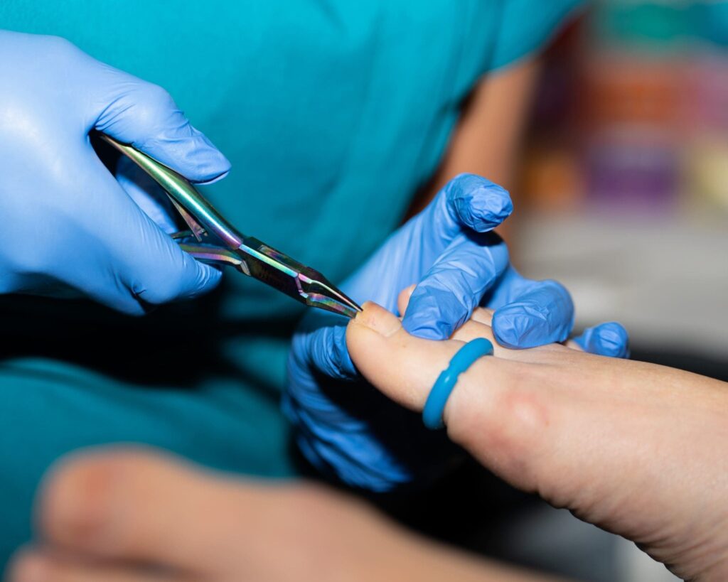 Nail Surgery - Hamlet Podiatry Clinic